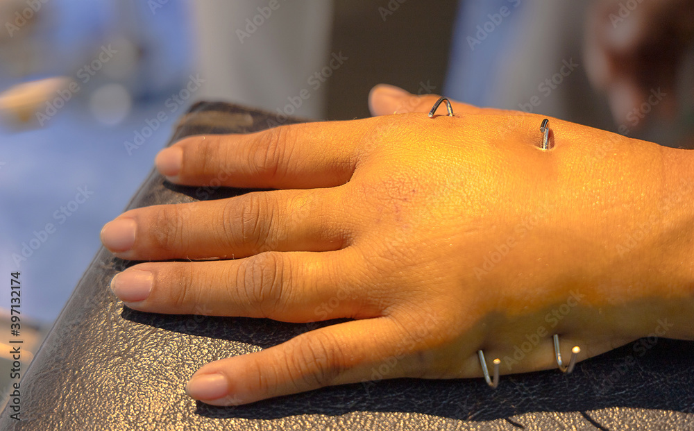 Internal fixation of hand fractures Stock Photo | Adobe Stock