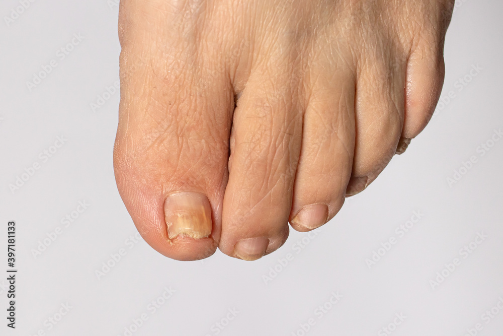 Fungus of nails on the big toe - dermatomycosis and onychomycosis ...