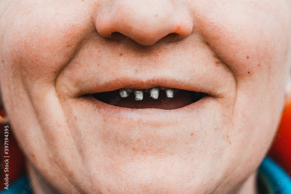 The woman opened her mouth wide, and showed her crooked and rotten ...