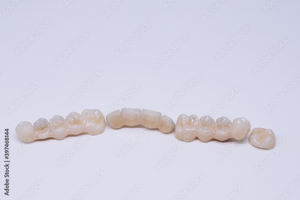 Beautiful ceramic teeth. Porcelain crown and bridge. Dental ceramic ...