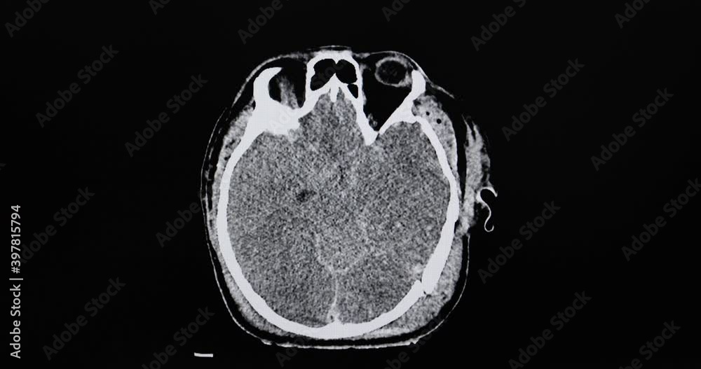 CT cine scan of a patient with falling injury showing severe depression ...