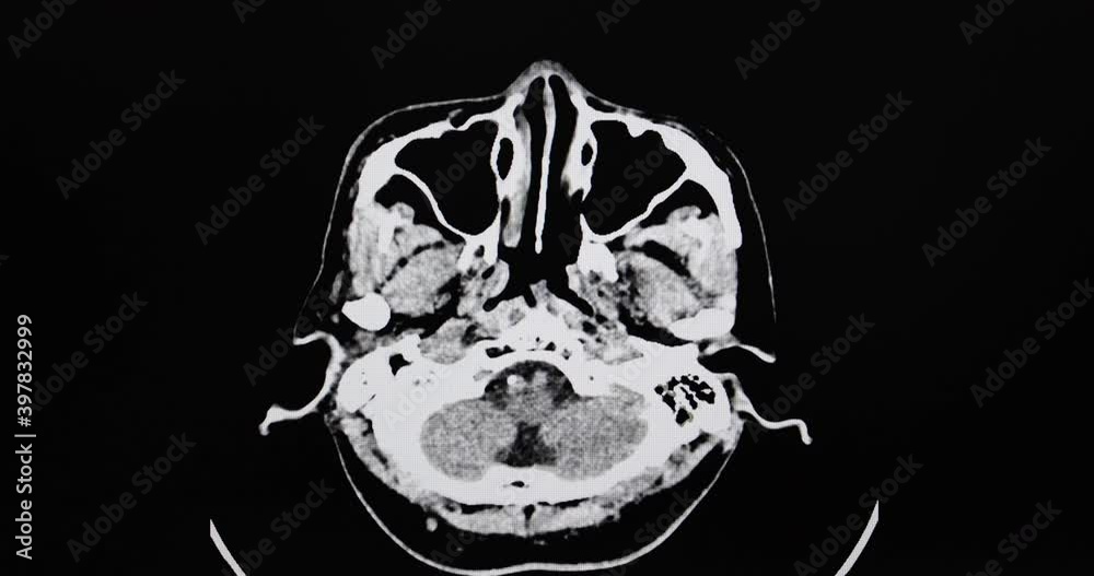 Multi screen CT cine scan of a patient post right craniectomy with ...