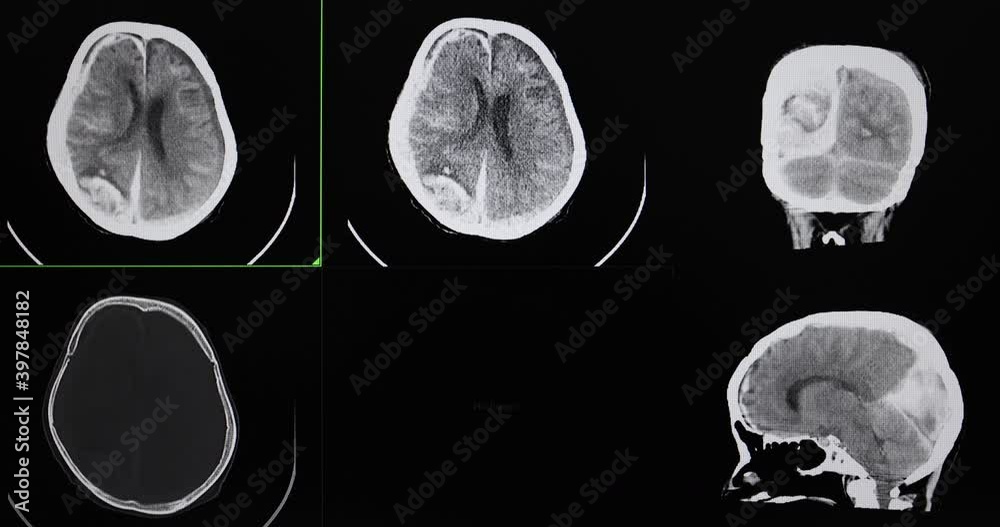 A CT cine scan of a traumatized patient showing intracerebral ...