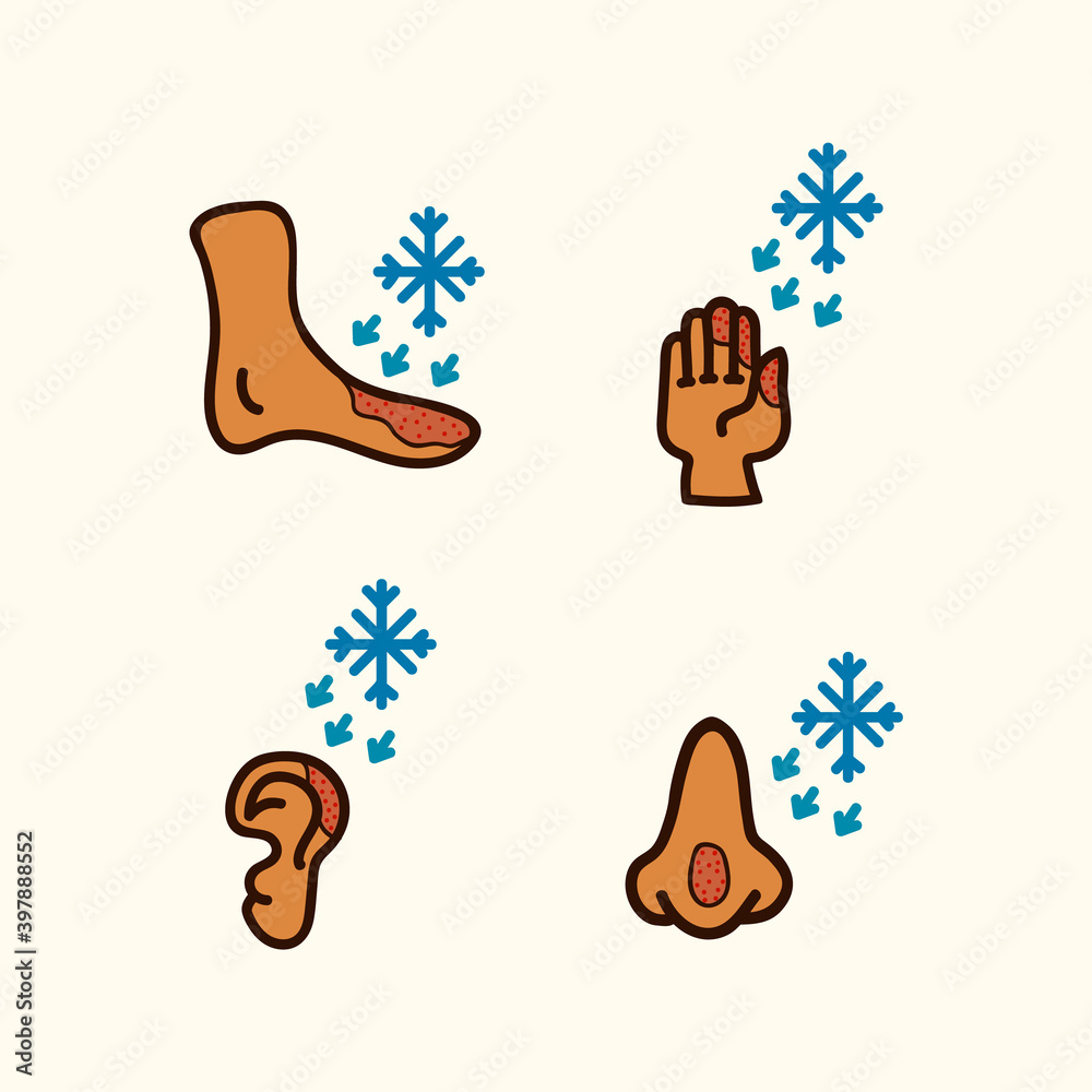 Frostbite icons. The linear vector color icons of frostbite of the ...