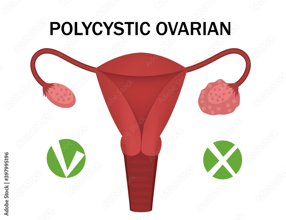 Polycystic ovary disease and a healthy ovary. medical infographics ...