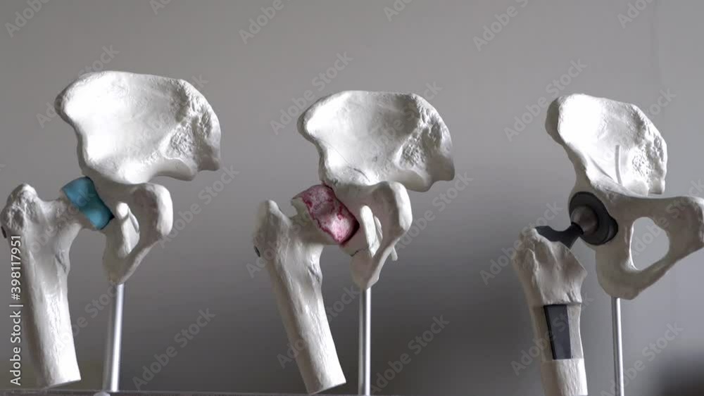 Stockvideo Hip joint model with implant. Three mock-ups of the hip ...