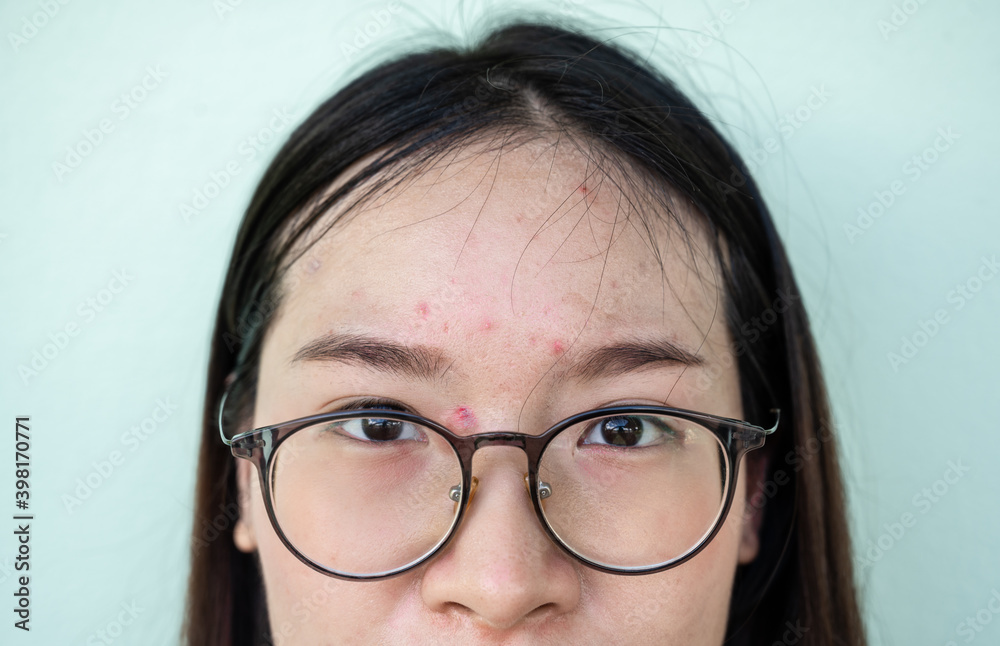 Close-up of Asian woman with pimple and acne inflamed on her forehead ...