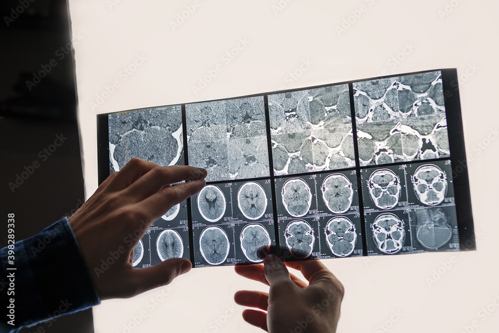 X-rays in the doctor's hand. X-rays of the human brain. Isolated on ...