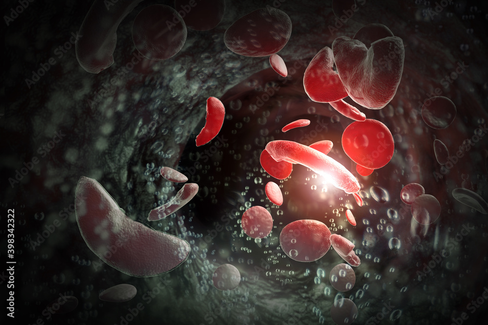 Sickle Cell Anemia 3D Illustration ilustración de Stock | Adobe Stock