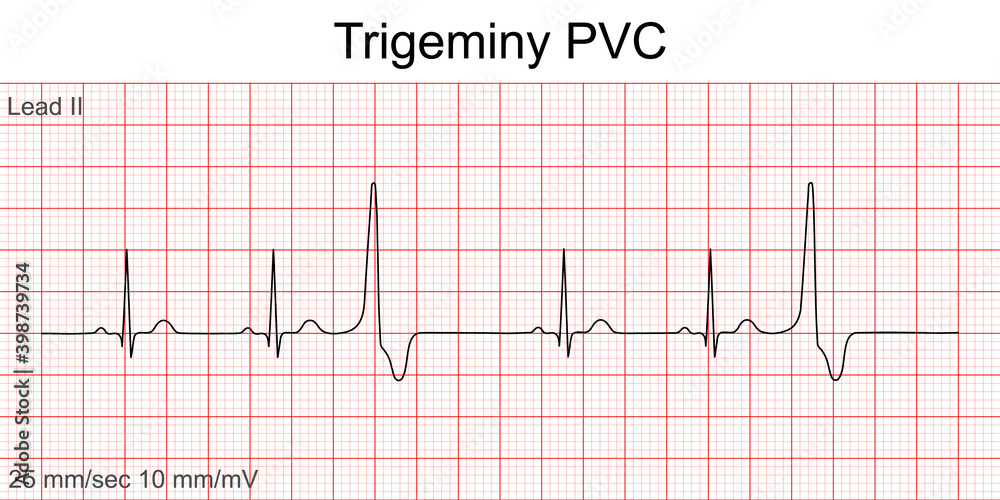 Electrocardiogram show ventricular fibrillation (VF) pattern. Cardiac ...