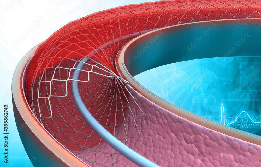 Balloon angioplasty. Medical concept. 3d illustration. Stock ...