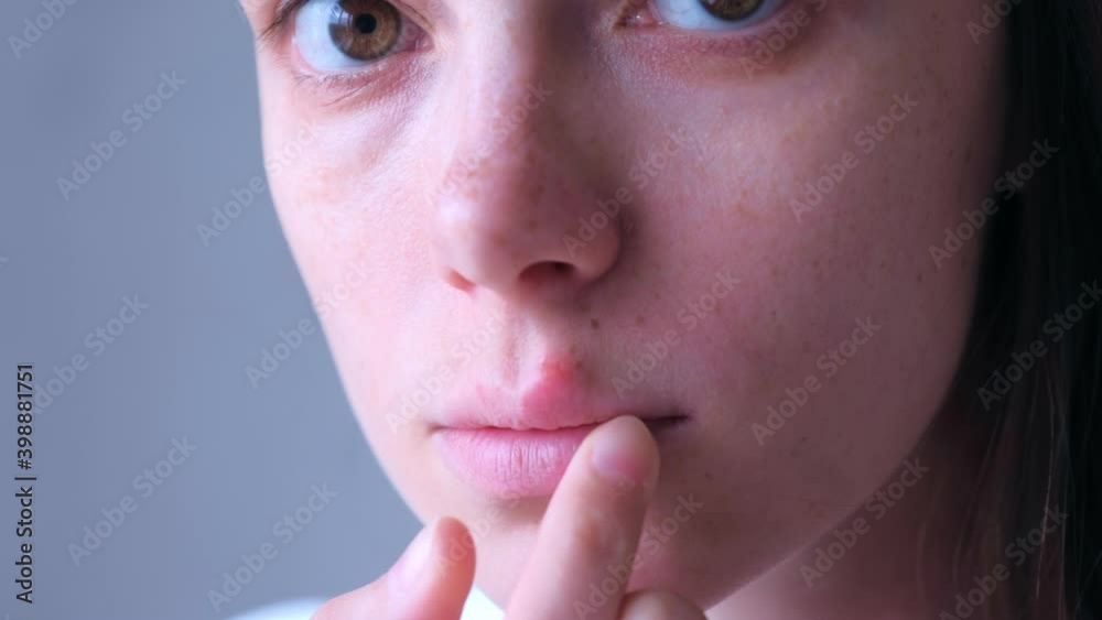 Herpes virus on human lips. Woman with herpes sore on upper lip on ...
