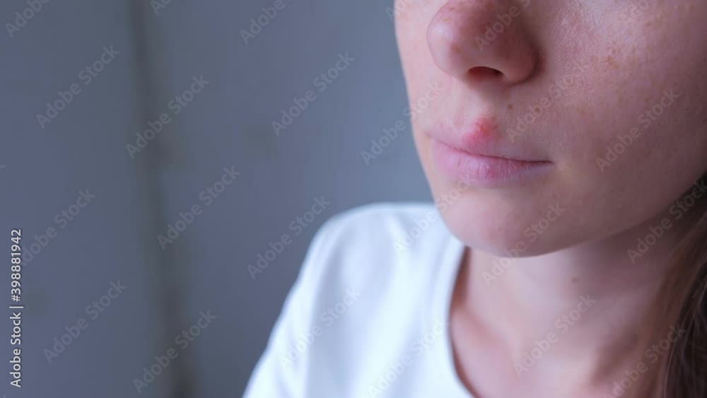 Herpes virus on human lips. Woman with herpes sore on lip mouth ...