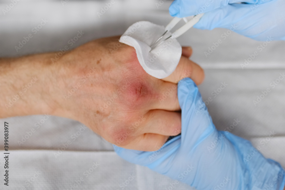 doctor treats a healing wound from an allergic reaction to chemicals on ...