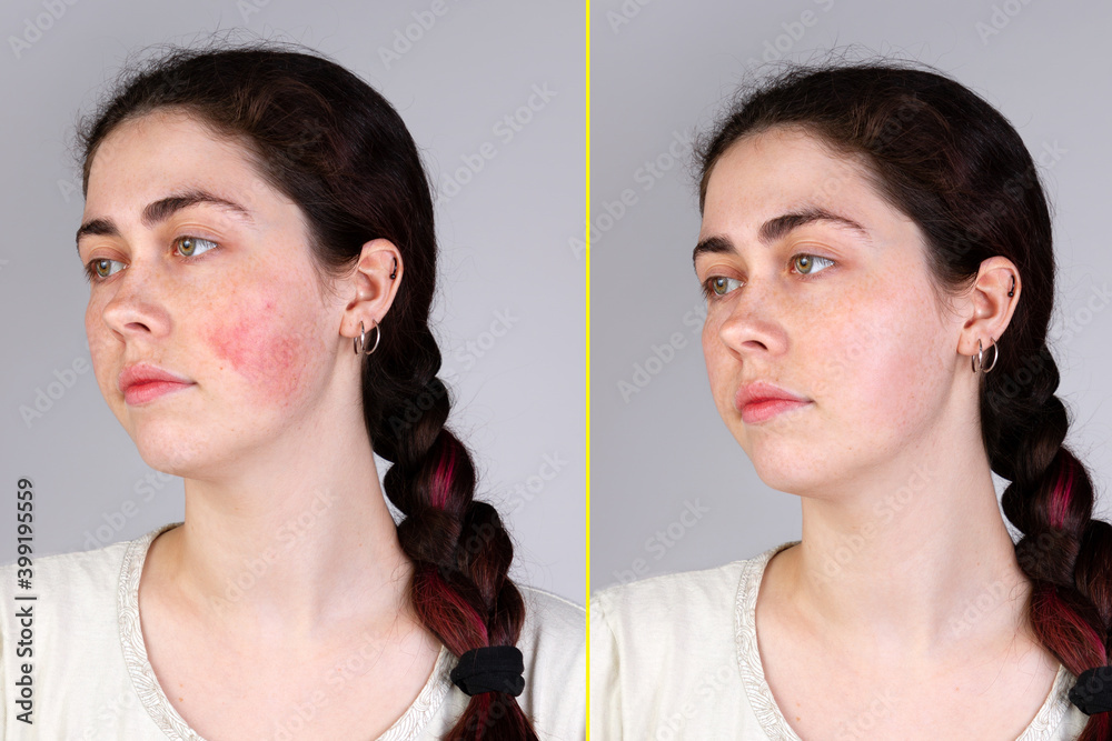 Portrait of a young caucasian woman with red and inflamed blood vessels ...