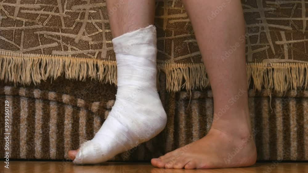 Girl rides on one leg Women leg in a plaster cast toes moving. Leg ...