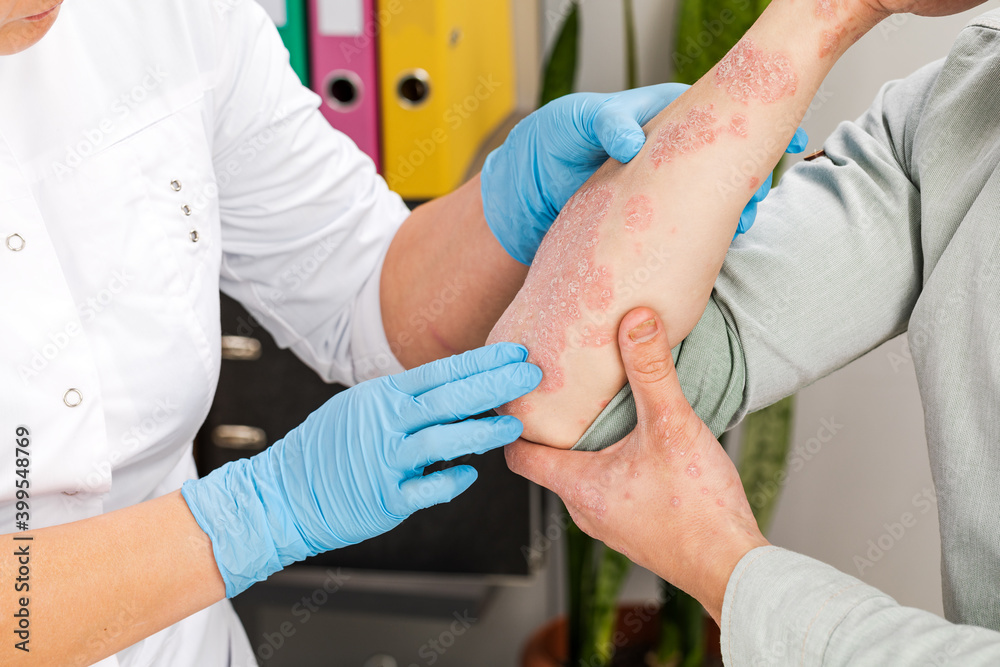 A dermatologist wearing gloves examines the skin of a sick patient ...