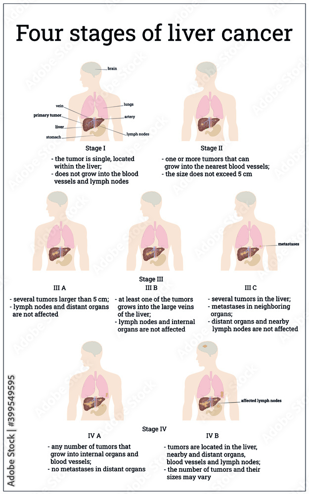 Four stages of liver cancer and five substages with a brief description ...