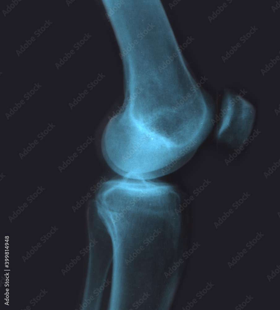 Human knee x-ray. Medical health anatomy diagnostic Stock Photo | Adobe ...