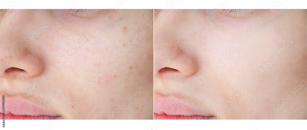 laser removal of freckles and age spots. before and after photos Stock ...