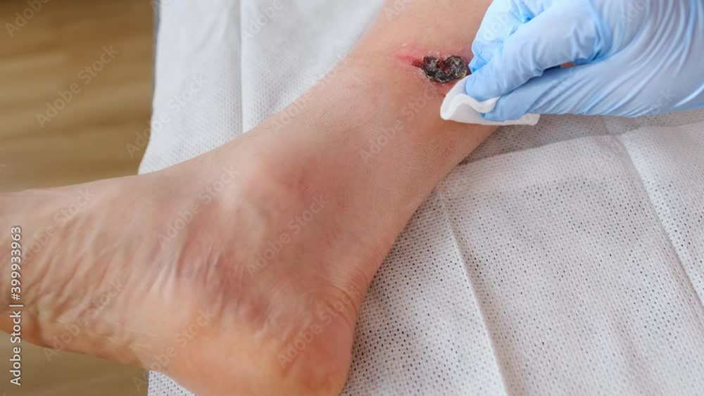 doctor treats a large healing wound from a severe burn on the leg of an ...