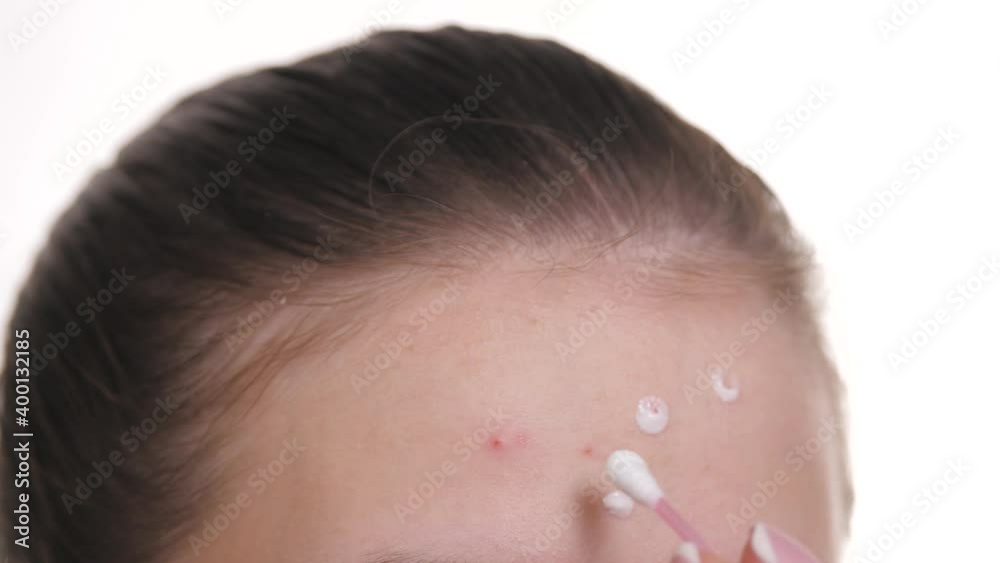 Young skin of the forehead with acne. Getting rid of the rash. Apply a ...