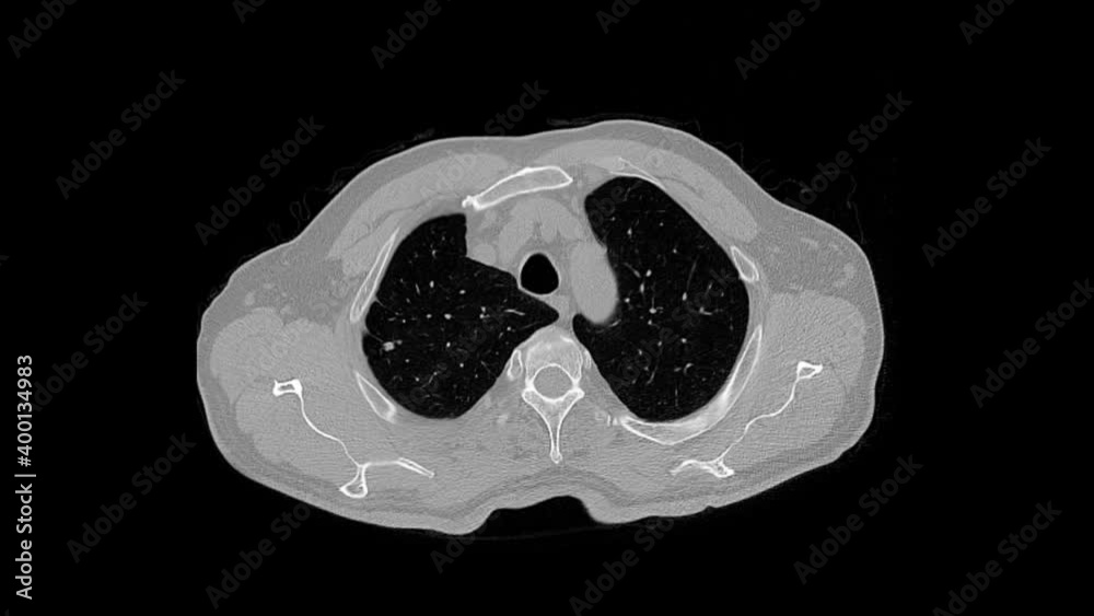 MRI of human lungs. Voluminous MRI of the lungs and bronchi, diagnosis ...