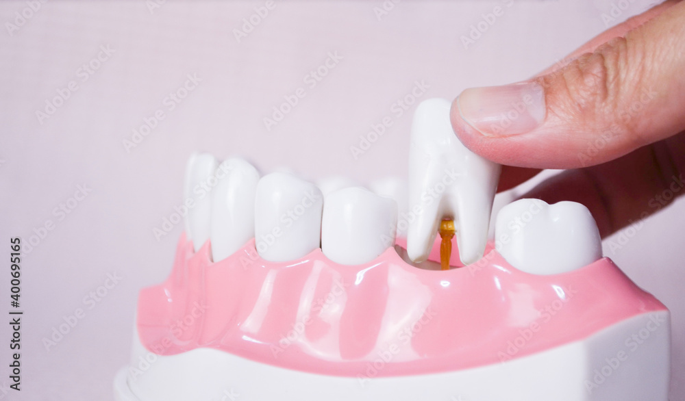 Foto de Hand extracting a tooth model,Hand pulling out a tooth model ...