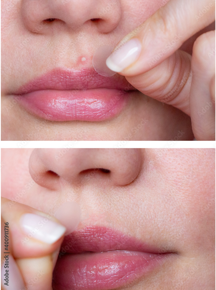A woman puts on a patch for inflamed acne. Result before and after ...