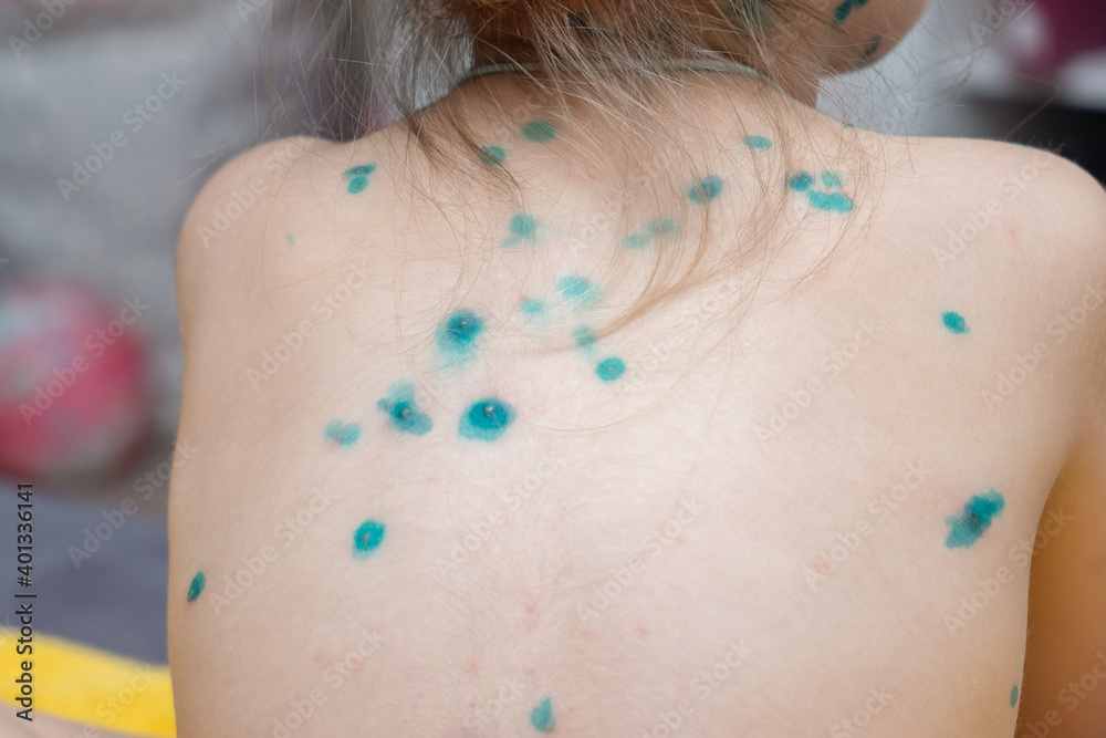 Child covered with green rashes the whole body ill with chickenpox ...