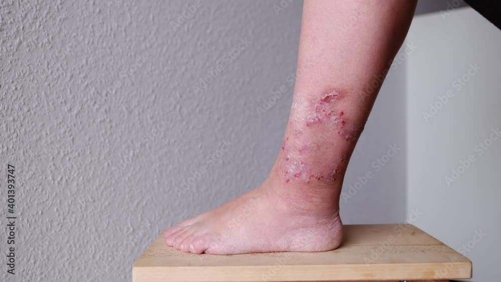 doctor treats a large healing wound from on lower leg with scars of ...