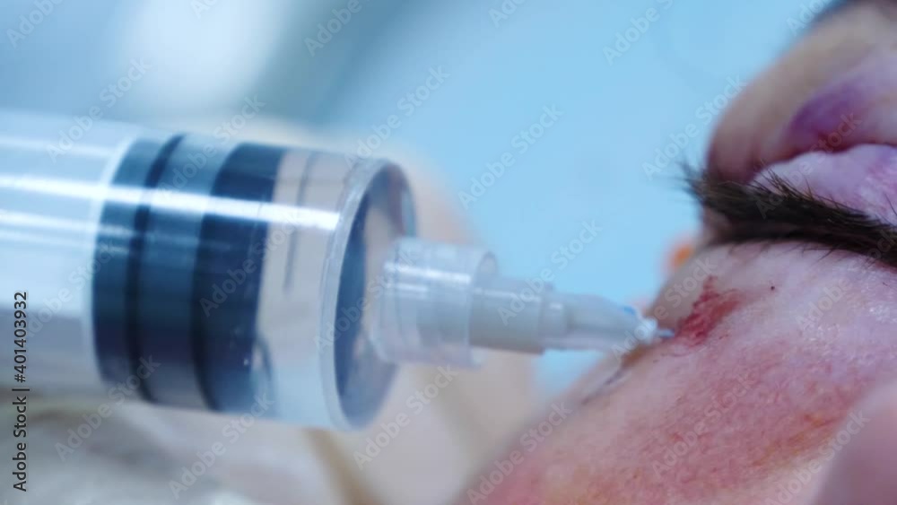 Upper blepharoplasty. The surgeon puts an injection in the patient eye ...