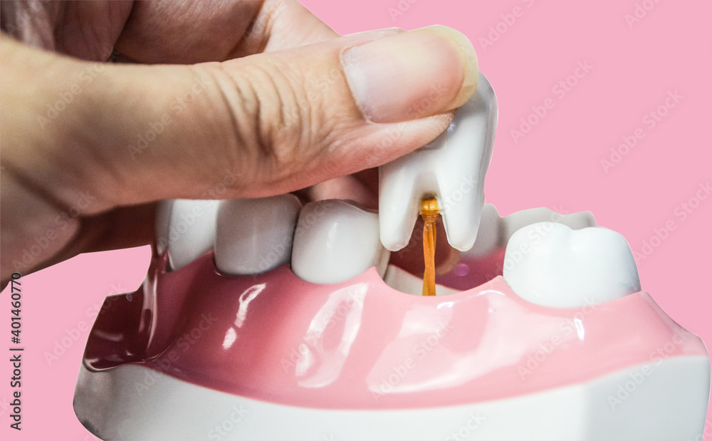 Hand extracting a tooth model,Hand pulling out a tooth model.Hand ...