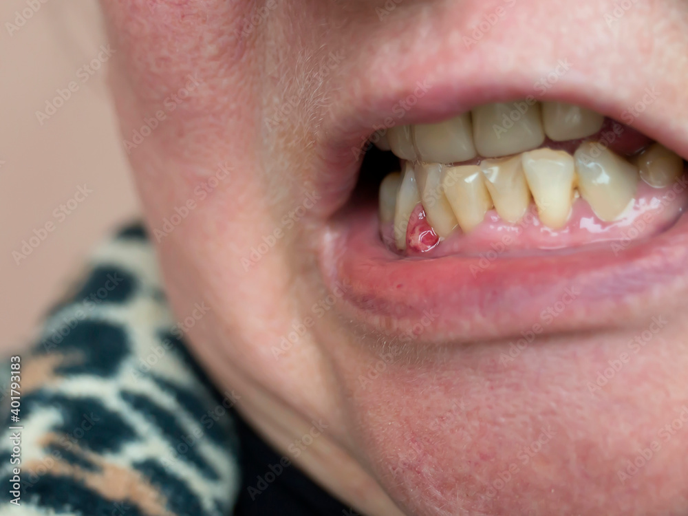On the gum, an abscess formed, a tumor with purulent contents. Dentist ...