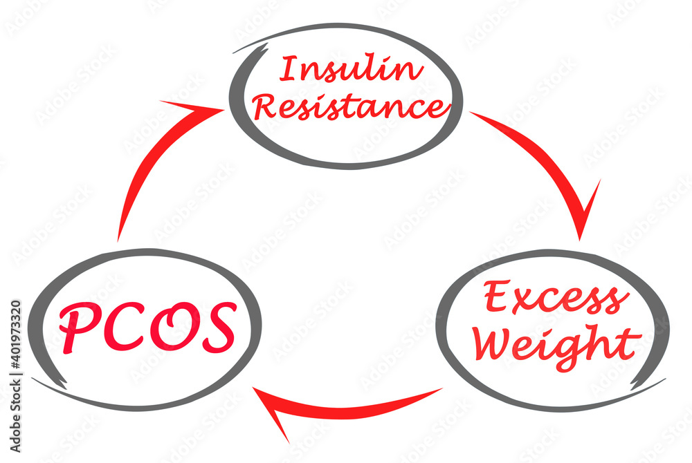 Cycle of Polycystic ovary syndrome (PCOS) Stock Illustration | Adobe Stock