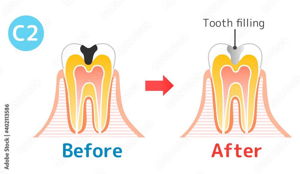 Caries and Progression and Treatment: Dental Illustration Stock Vector ...