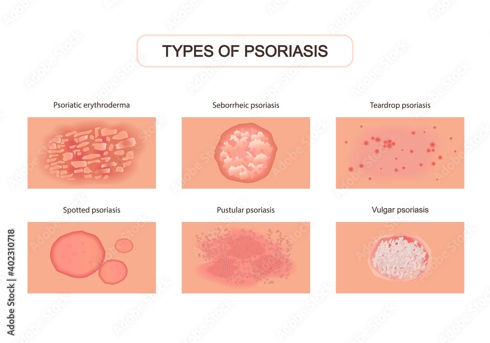 Varieties of psoriasis set. Red eruptions on skin with ulcers and ...