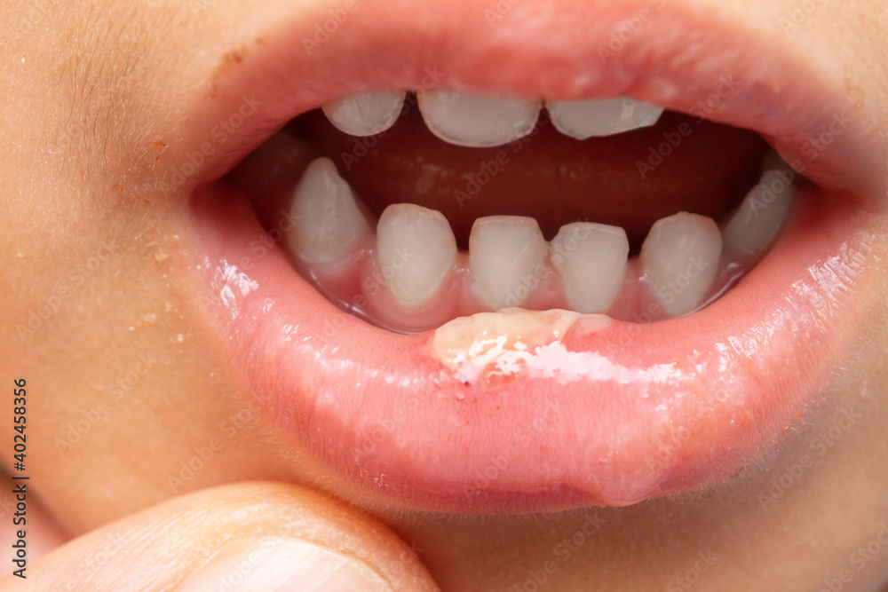 Child having a swollen lower lip, caused by mouth ulcers. foto de Stock ...
