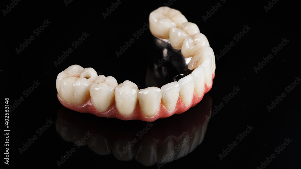 aesthetics of the lower ceramic prosthesis on a black background Stock ...