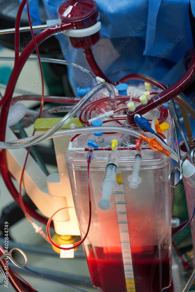 Cardiopulmonary bypass,circulation blood heart lung machine for heart ...