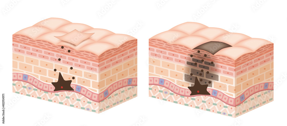 Cross section of the skin 2 No commentary Stock Vector | Adobe Stock