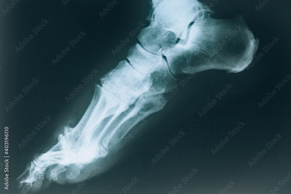 Foto de X-ray of the foot. Injury to the bones of the foot. Sports ...