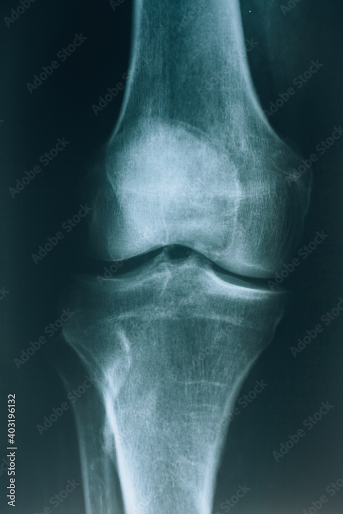 X-ray of the knee joint. Knee bone injury Stock Photo | Adobe Stock
