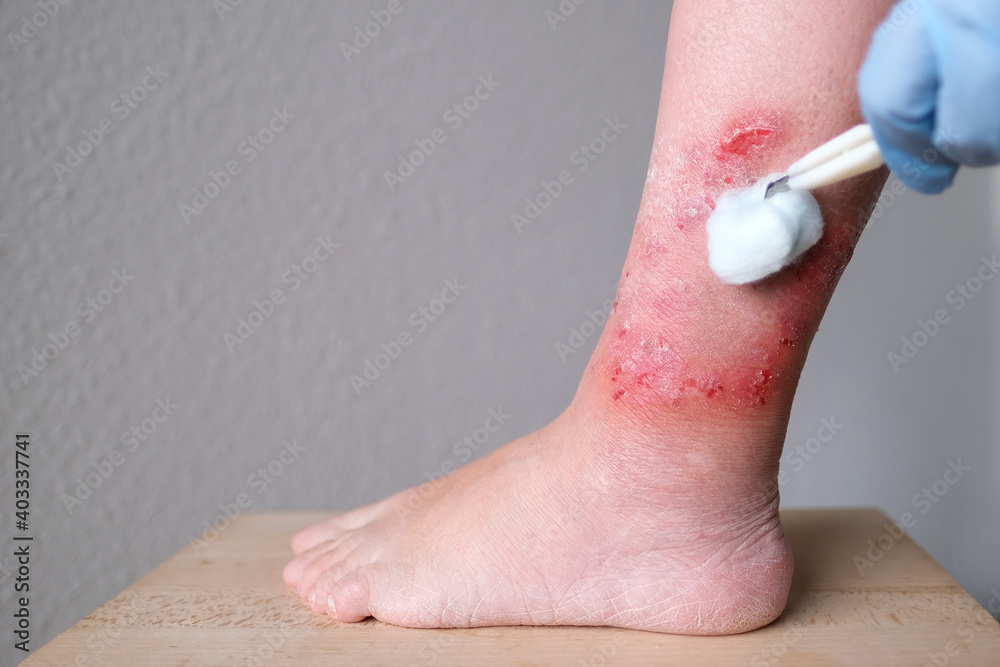 Foto de doctor treats a large healing wound from on lower leg with ...