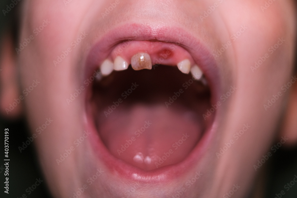 Little baby toothless kid mouth,children health teeth care,dentistry ...
