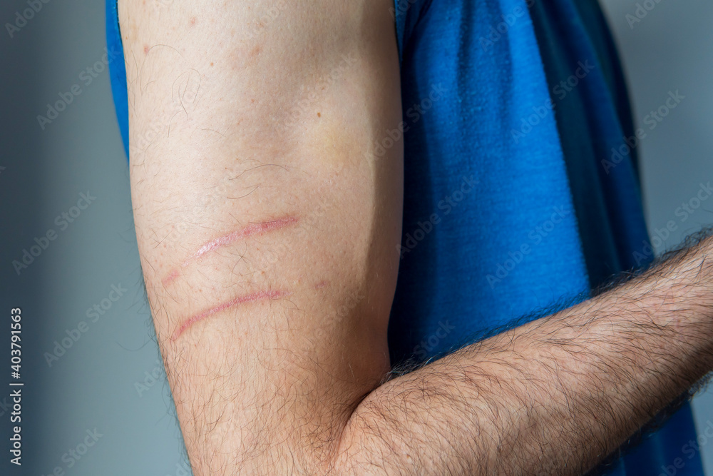 Man's athlete arm with two long healing scars from scratches. Wounds on ...