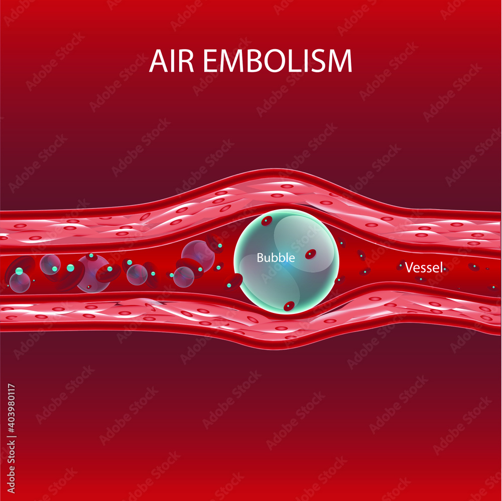 air bubble in vessel cause of decompression illness treatment by ...