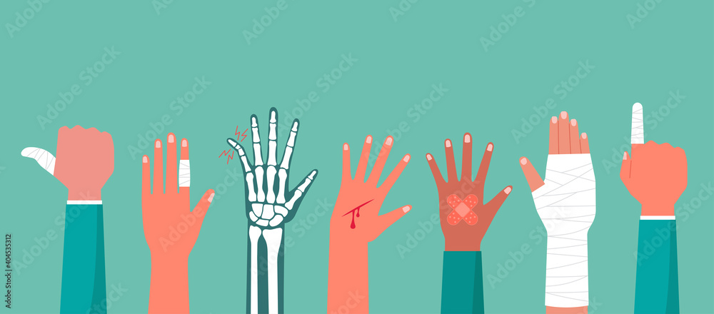 Concept of the human hand trauma injury with X-ray of broken bone ...
