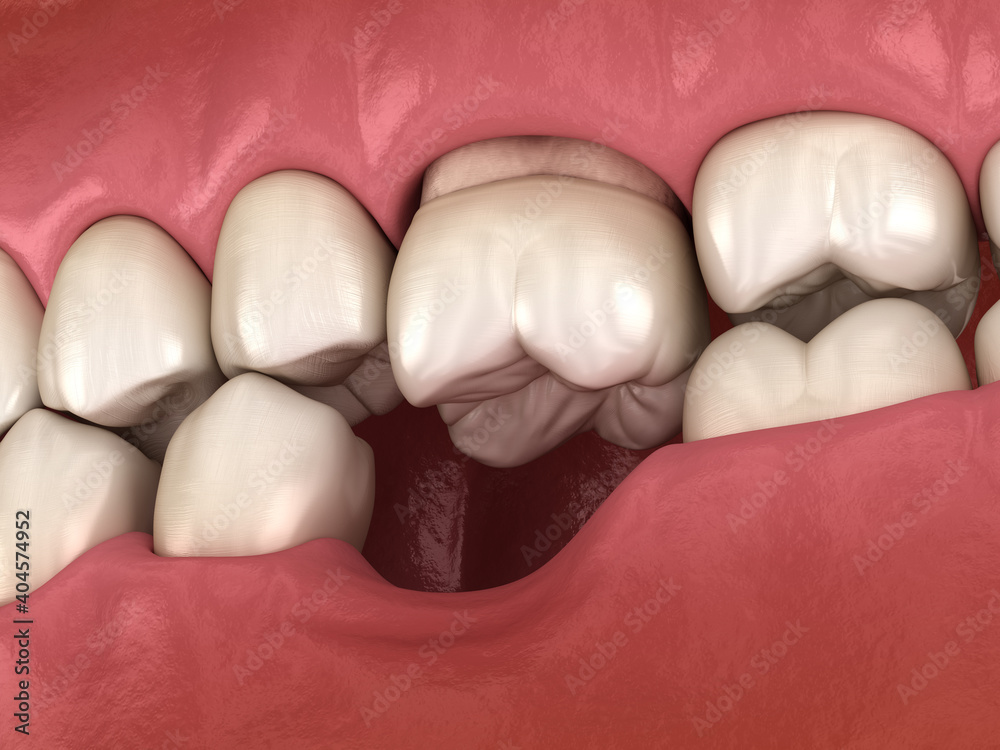 Teeth shift deformatiuon after losing molar tooth. 3D illustration of ...