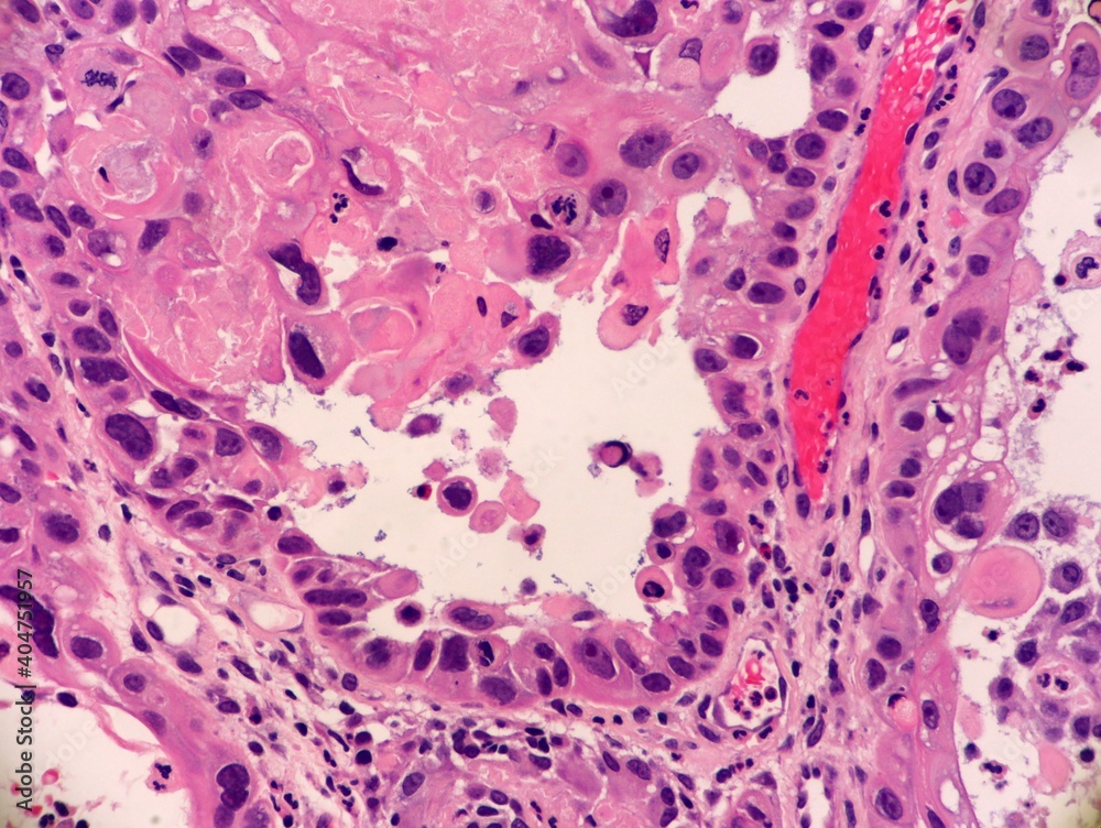Skin cancer called squamous cell carcinoma. Notice the large, atypical ...